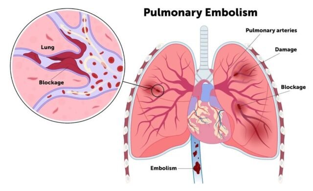 Understanding Pulmonary Embolism: Causes, Symptoms, and Prevention